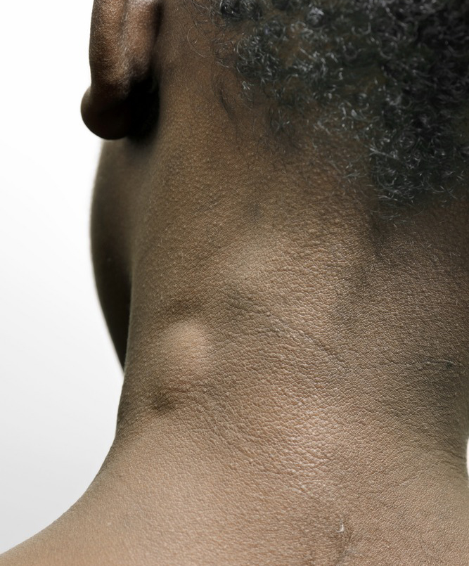 Lymfesystemets oppbygning og funksjon - Helsefremmende arbeid (HS-HSF ...